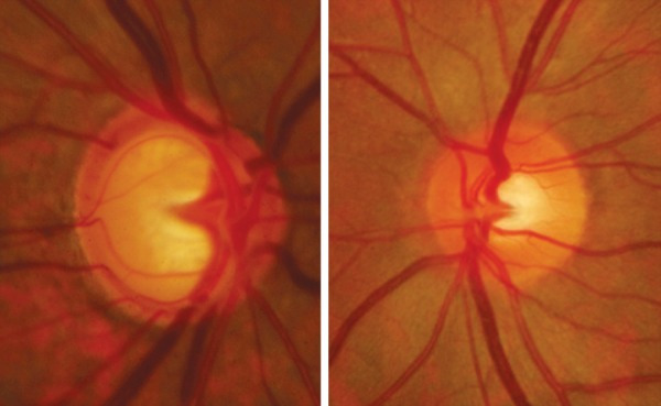 Temporal unfolding, Nasal cupping, Overpass cupping