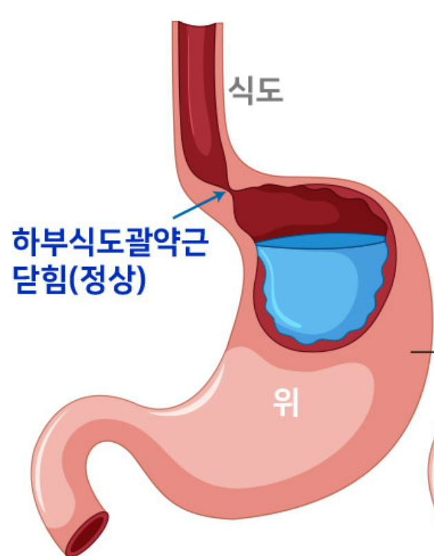 역류성식도염약 케이캡정50mg 부작용 가격 성분 정리 5분전 유용한 건강 요리 소식