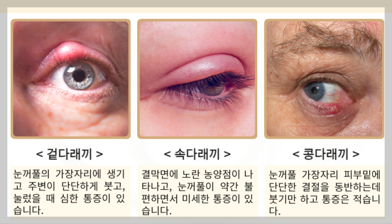 건강정보 눈 다래끼 빨리 낫는법 눈 다래끼 전염 증상 원인 눈 점막 부음