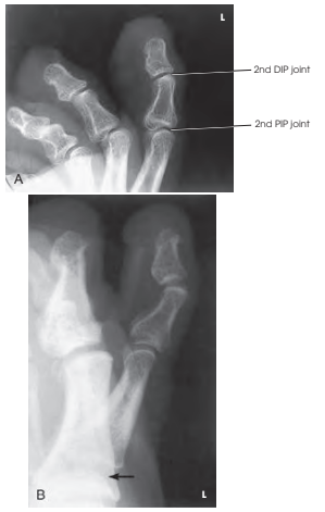 Toe LAT projection, 발가락 Lateral 촬영법