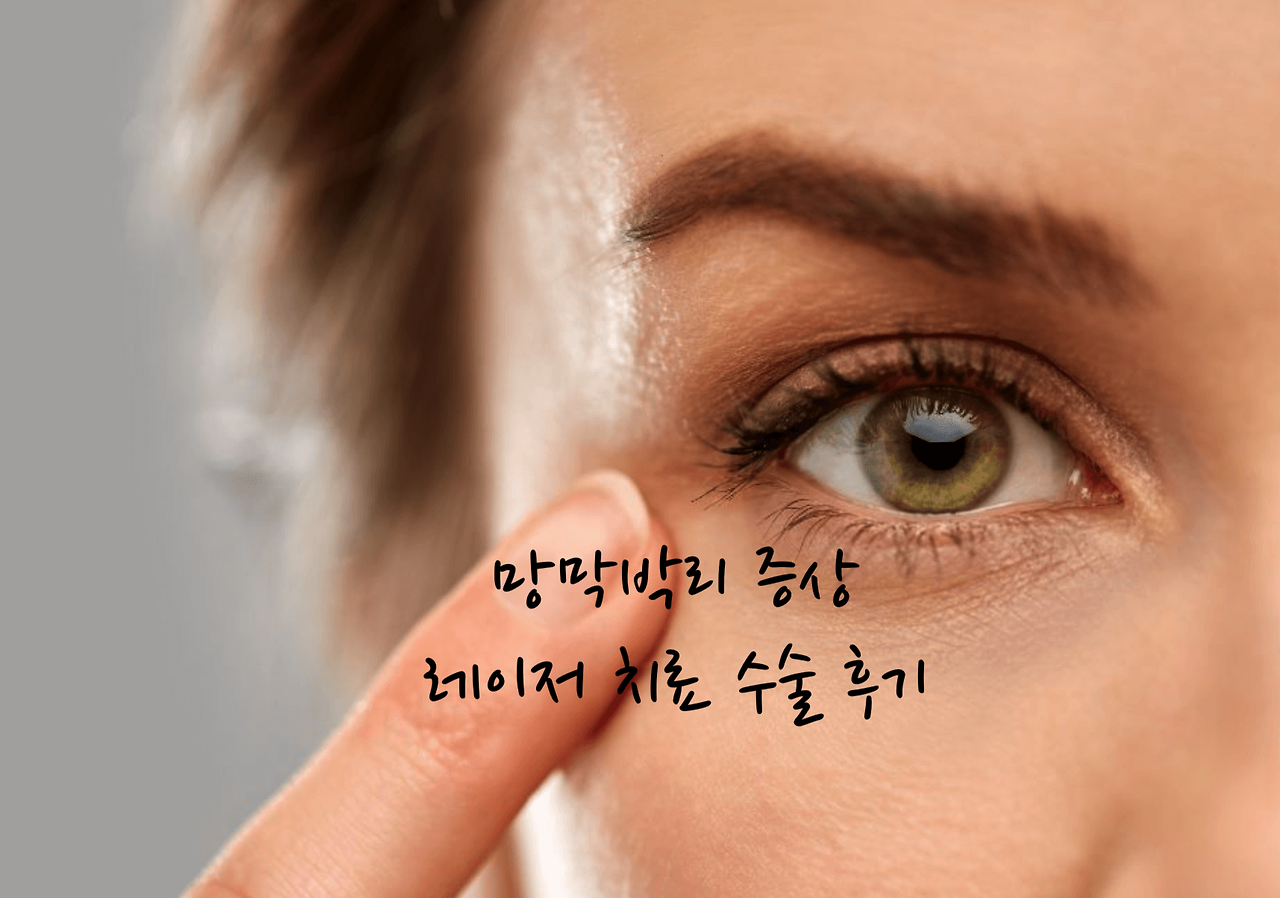 망막박리 증상 레이저 치료 수술 후기