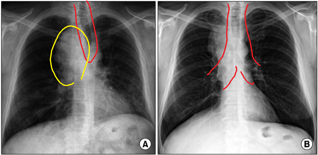 흉부 x ray의 해석 - 체계적인 접근법(chest PA)