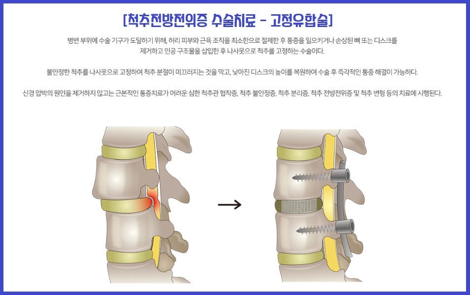 척추전방전위증 증상과 치료 운동까지
