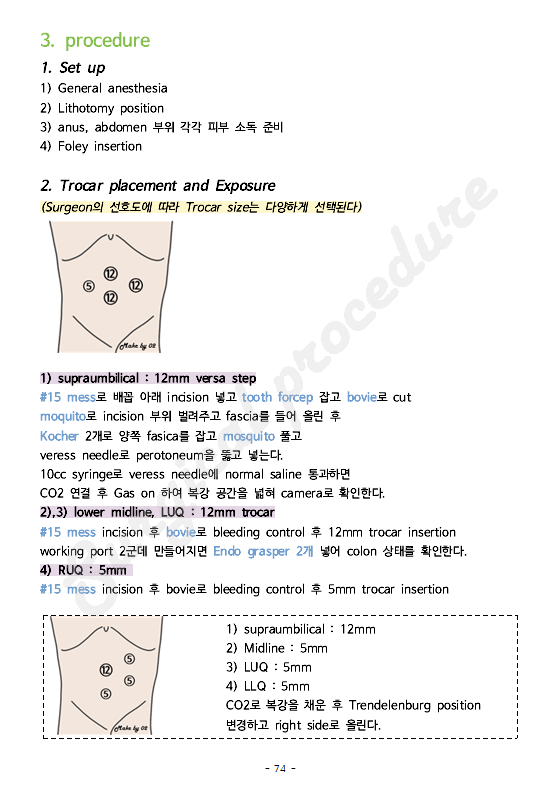 Gs Laparoscopic Right Hemicoloctomy 복강경하 우측 결장 반절제술 수술 과정