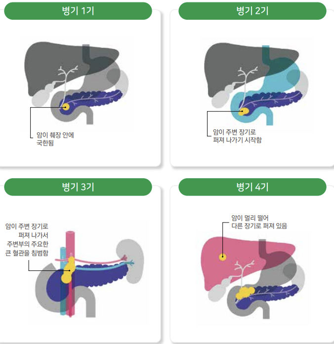 췌장암 초기증상 10가지 자세히 알아보자