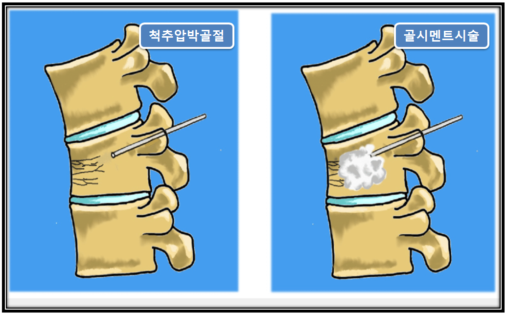 처음 경험한 척추압박골절과 처음 듣는 골시멘트 시술 이야기에 환자나 보호자는 병원 상담사 의사의 말을 듣고 골시멘트술을