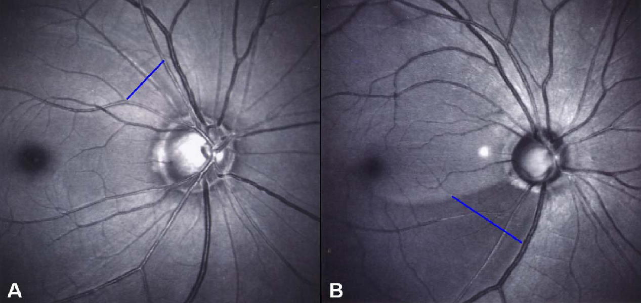 국소 망막신경섬유층 결손 RNFL defect 와 ISNT rule, IST rule