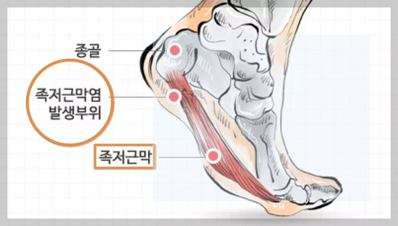 근저족막염 원인 증상 치료 방법 총정리