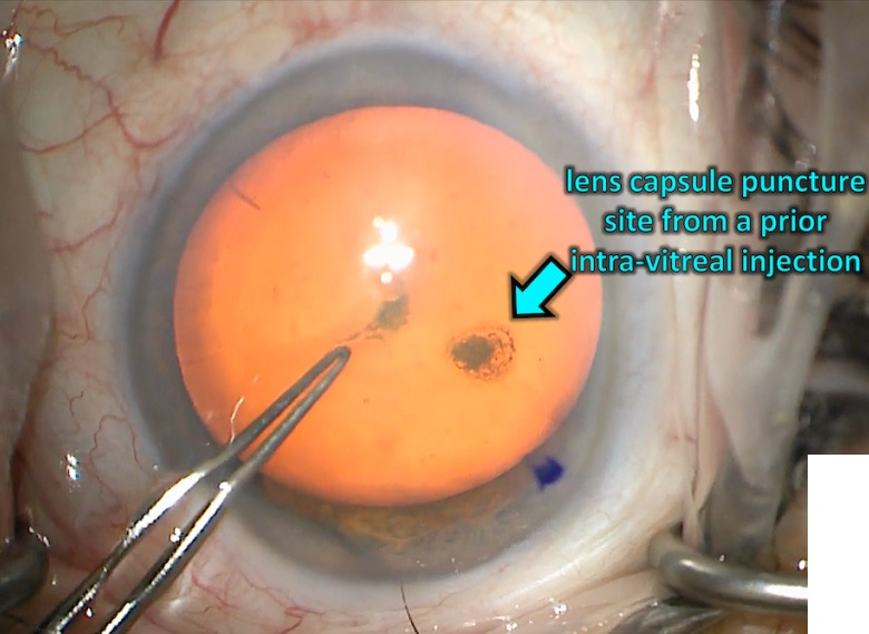 수정체 단백질성 녹내장, lens protein glaucoma, lens particle glaucoma