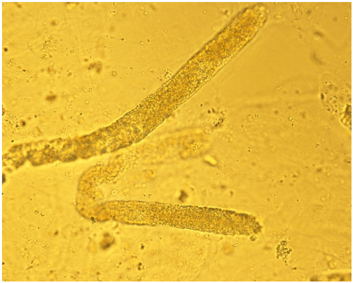 Urine요검사(요침사) 현미경검사(Micro Analysis)총정리"