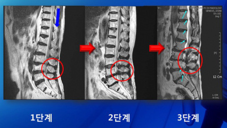 척추관 협착증 증상과 원인 치료방법