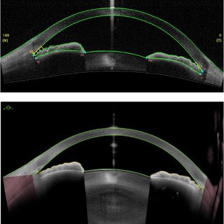 초음파 생체 현미경 검사 (UBM, Ultrasound BioMicroscopy)