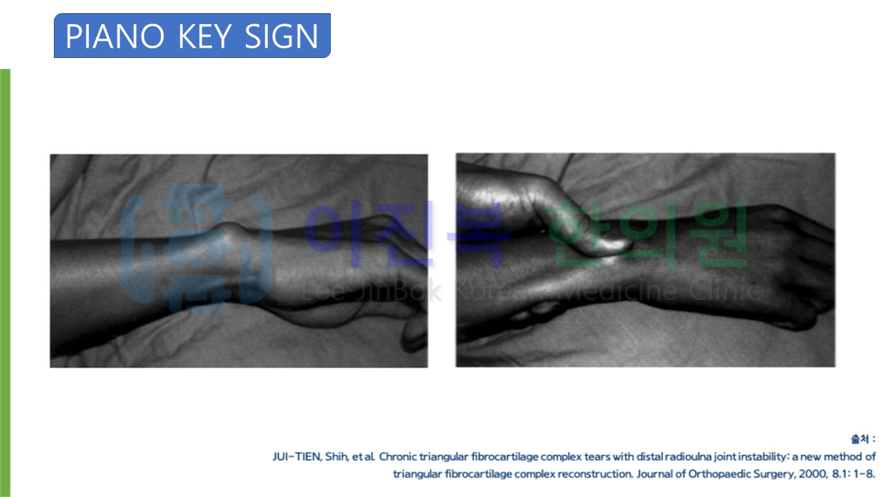 전주 이진복한의원 삼각 섬유 연골 복합체 병변(TFCC lesion)