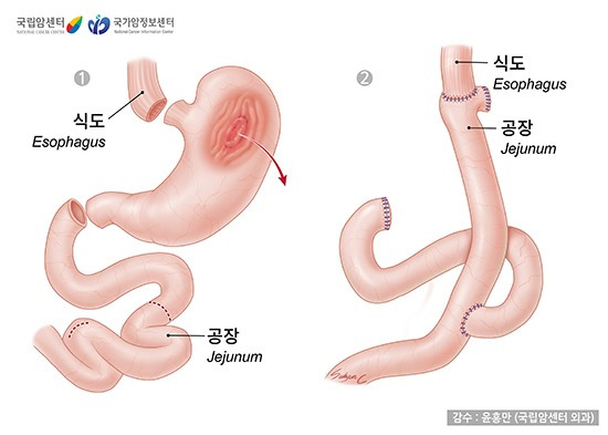 위암 기록하기 2 수술종류 및 방법 오늘의 스캘핑