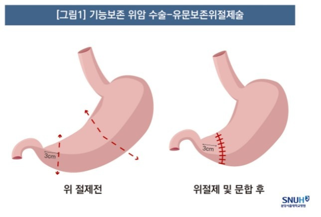 위암 기록하기 2 수술종류 및 방법 오늘의 스캘핑