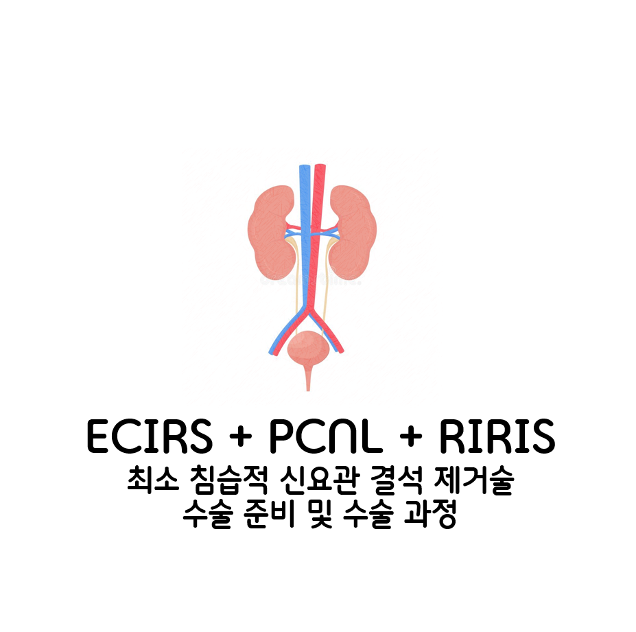 URO / ECIRS + PCNL + RIRS (최소 침습적 신장 요관 결석 제거술) 수술과정