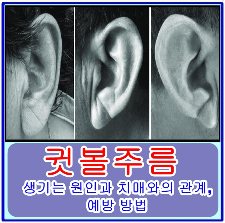 귓볼주름이 생기는 원인과 치매와의 관계 그리고 예방 방법