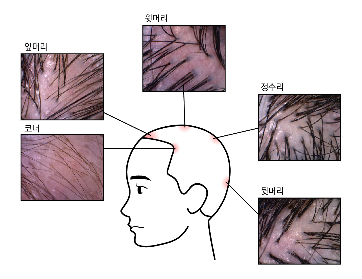 맵핑mapping을 통한 탈모 진행의 객관적인 평가