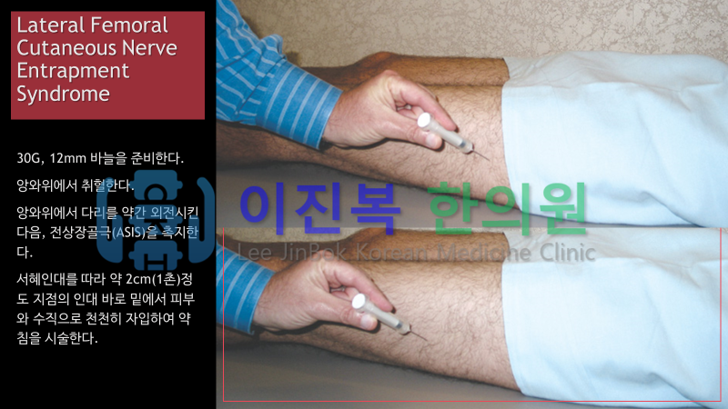 전주 이진복한의원 외측대퇴경피신경 포착증후군