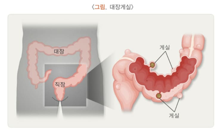 게실염 증상 원인 진단 치료 예방
