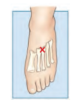 Foot AP projection, 발 AP, axial 촬영법