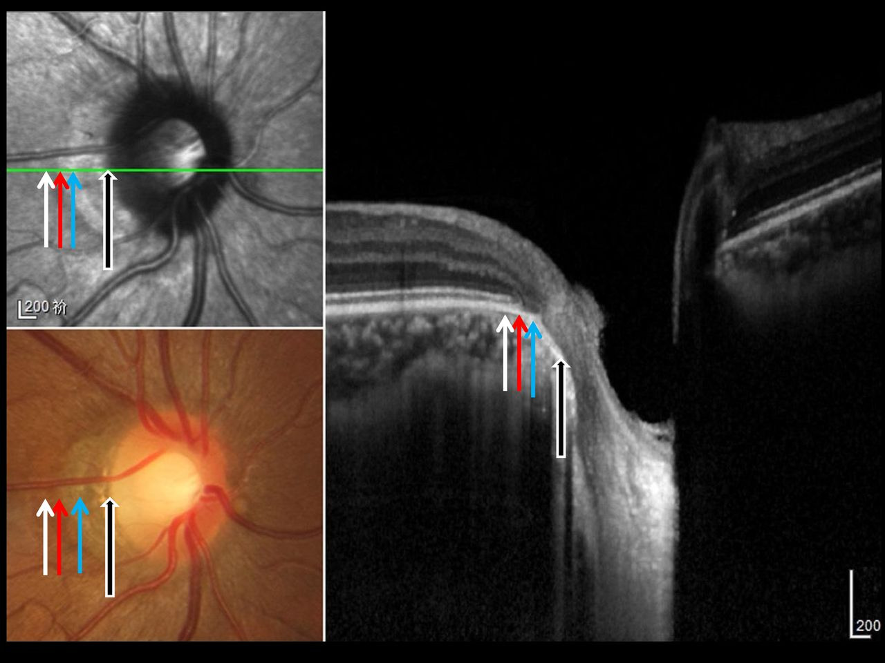 유두주위 맥락망막위축, Peripapillary atrophy, PPA 와 노년성경화, Senile sclerosis