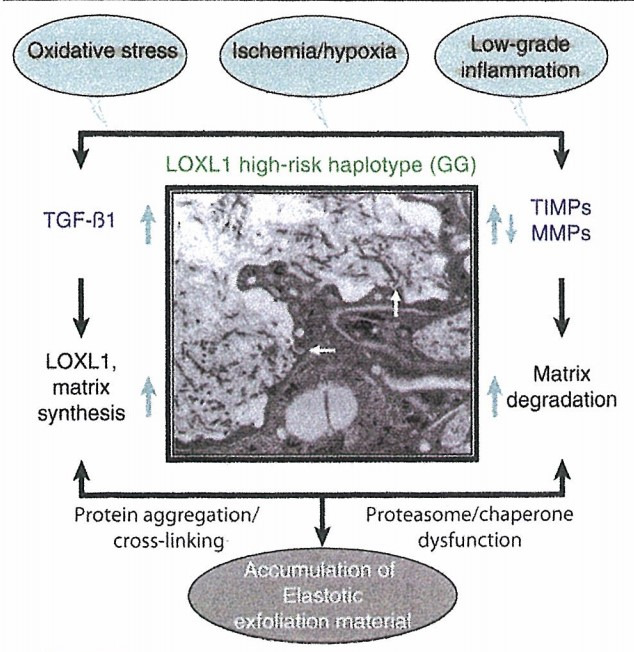 거짓비늘증후군(Pseudoexfoliation syndrome, PEX, PXS)의 원인, 유전자, 특징, 진행