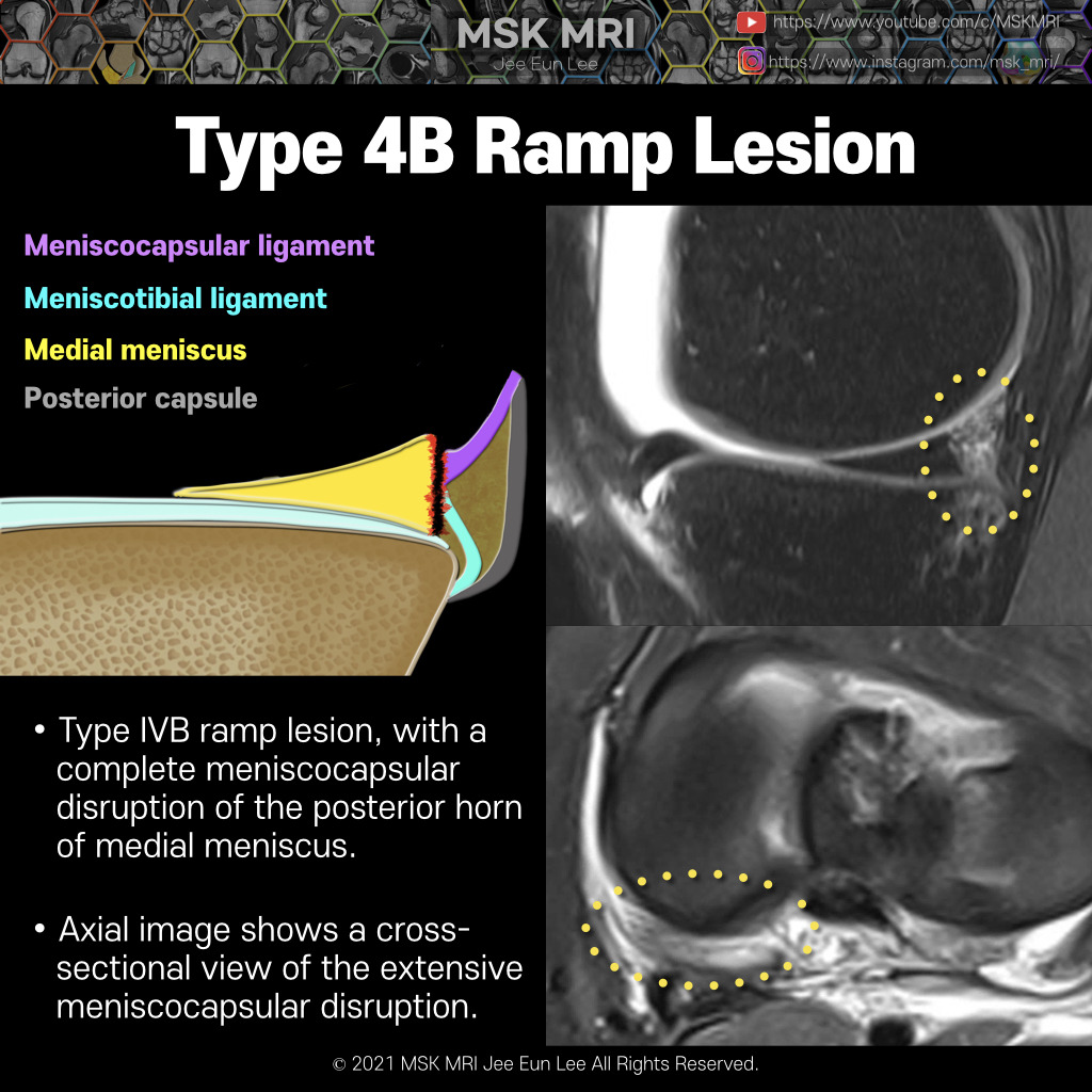 [Tear_28] Ramp lesion_Pitfalls, perimeniscal fluid, edema of posterior ...