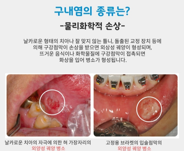 구내염 빨리 낫는법 A To Z