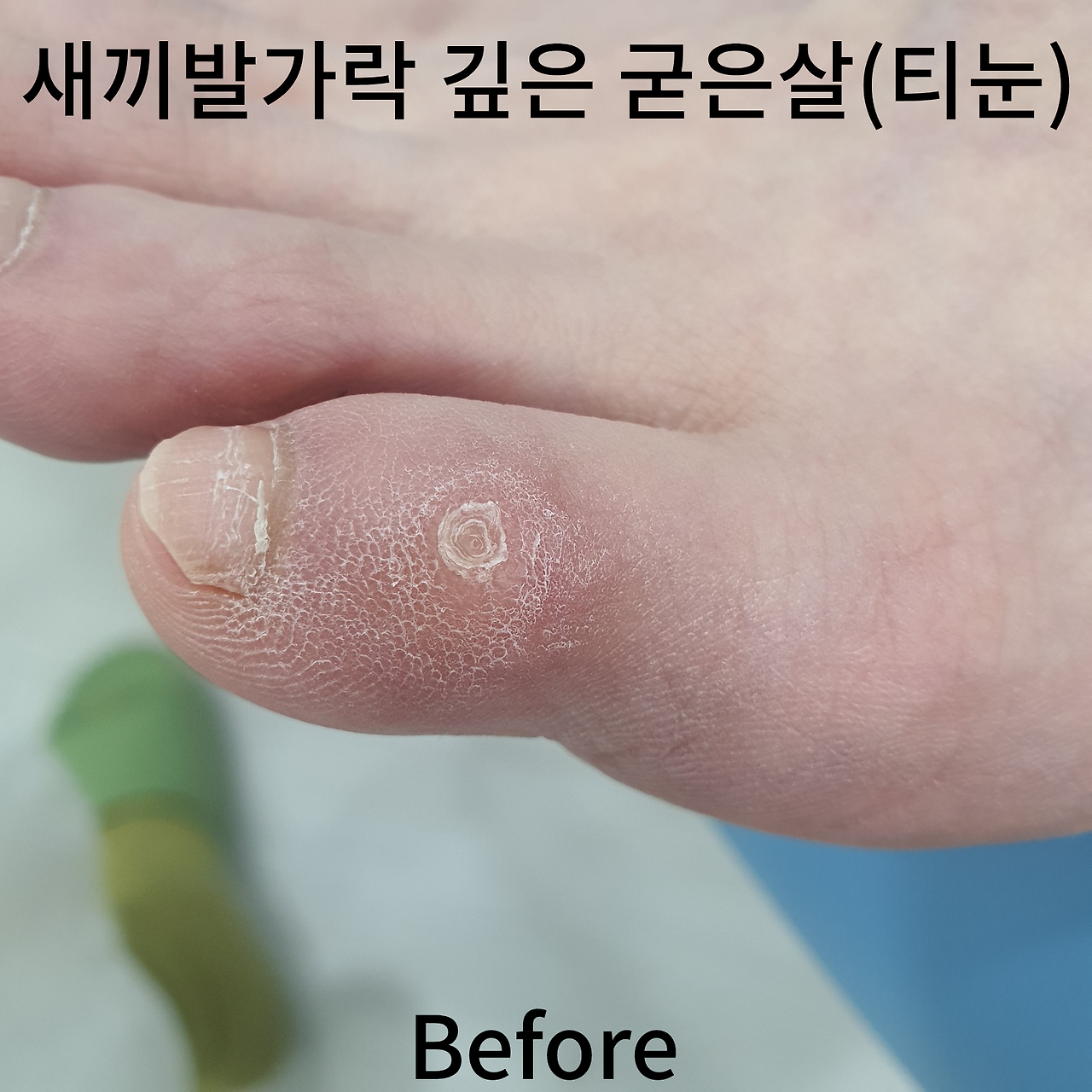 새끼발가락 단단한 굳은살티눈관리 풋스올 은평연신내점