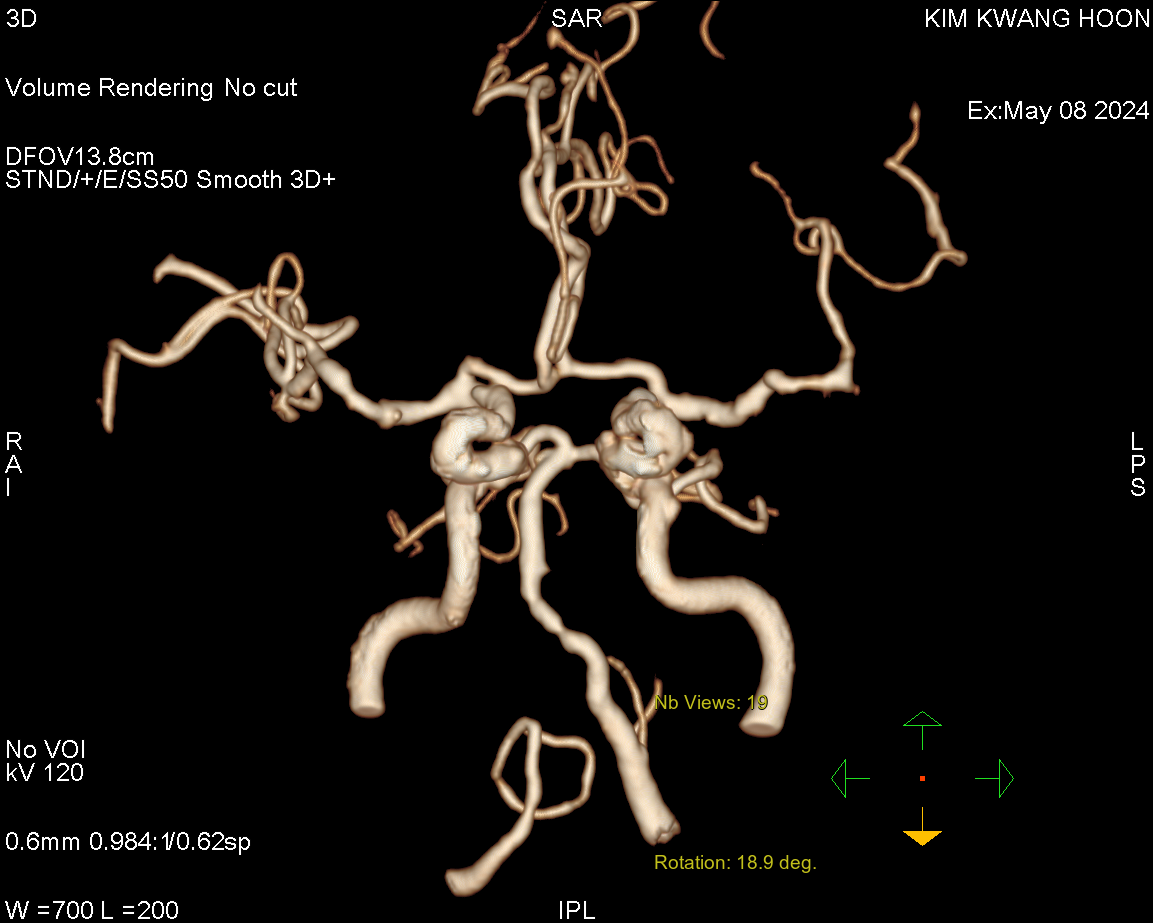 응급실 증례 Critical Time을 놓친 뇌졸중 환자mca Infarction