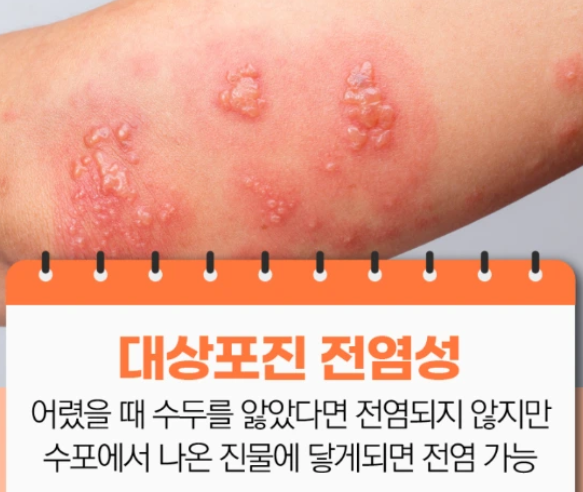대상포진 초기증상 후유증 전염성 재발 원인 예방접종 치료 방법