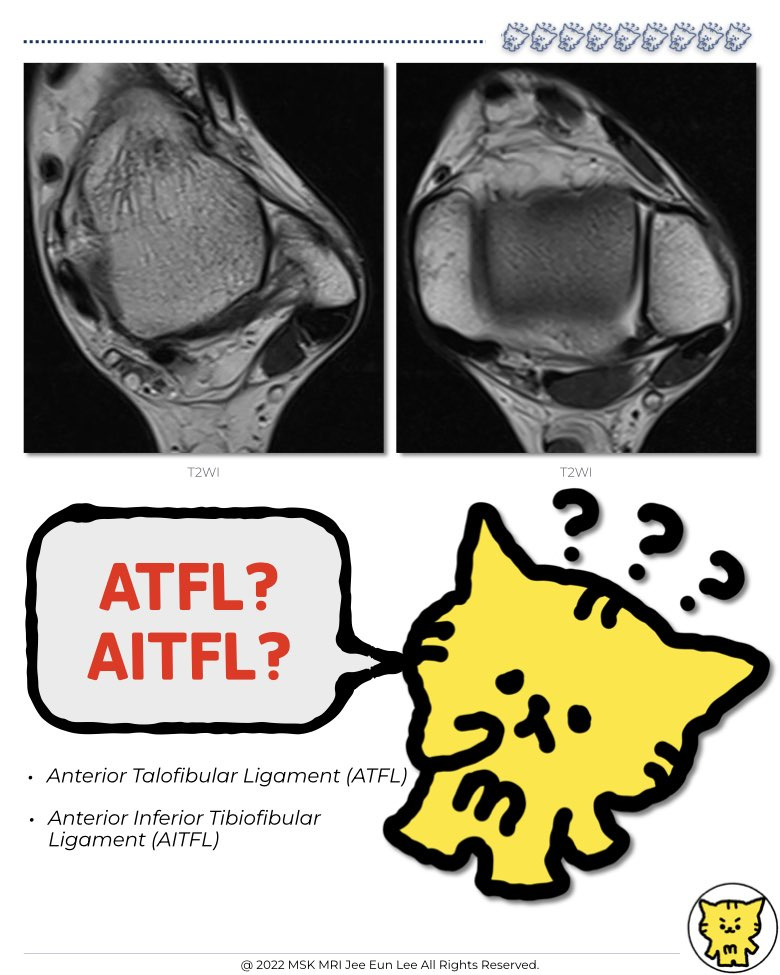 [Essential] Comparison Between ATFL and AITFL: Key Insights for Ankle ...