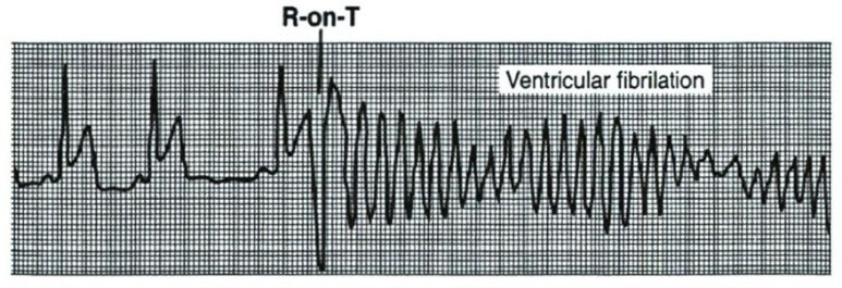 조기박동(Premature complex) | 심방조기수축(PAC)과 심실조기수축(PVC) | R-on-T 현상 | 방실접합부 ...