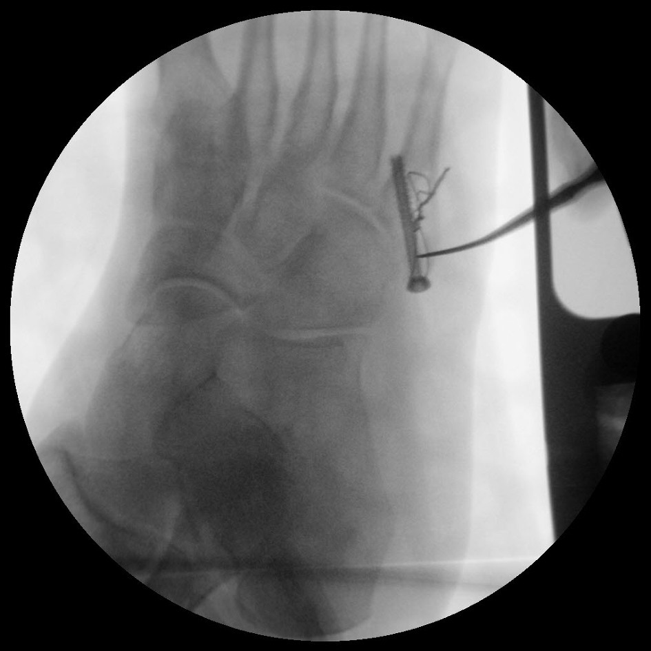 제5중족골 기저부 골절 Jones Fracture 존스 골절