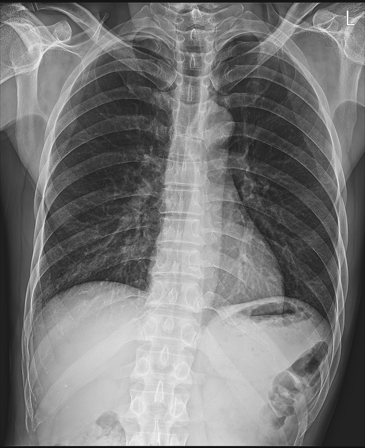응급실 증례 Multiple Rib Fracture 다발성 갈비뼈 골절