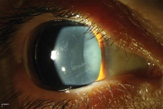 Posterior Polymorphous Corneal Dystrophy (PPMD/PPCD) symptom, treatment ...