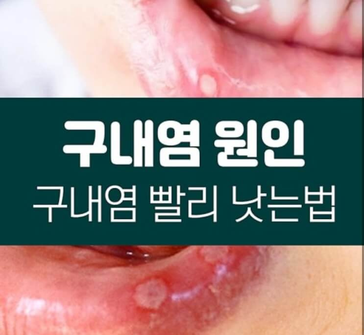 구내염 빨리 낫는 6가지 방법과 전염 아기 구내염 증상에 대해 알아봅시다