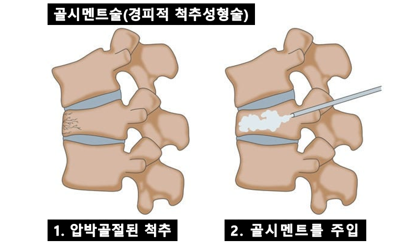 골다공증 척추압박골절 골시멘트 시술 비용골시멘트술 비용척추체성형술 비용