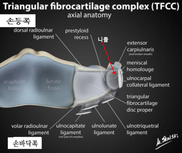 질병 손목 삼각섬유연골복합체 손상tfcc