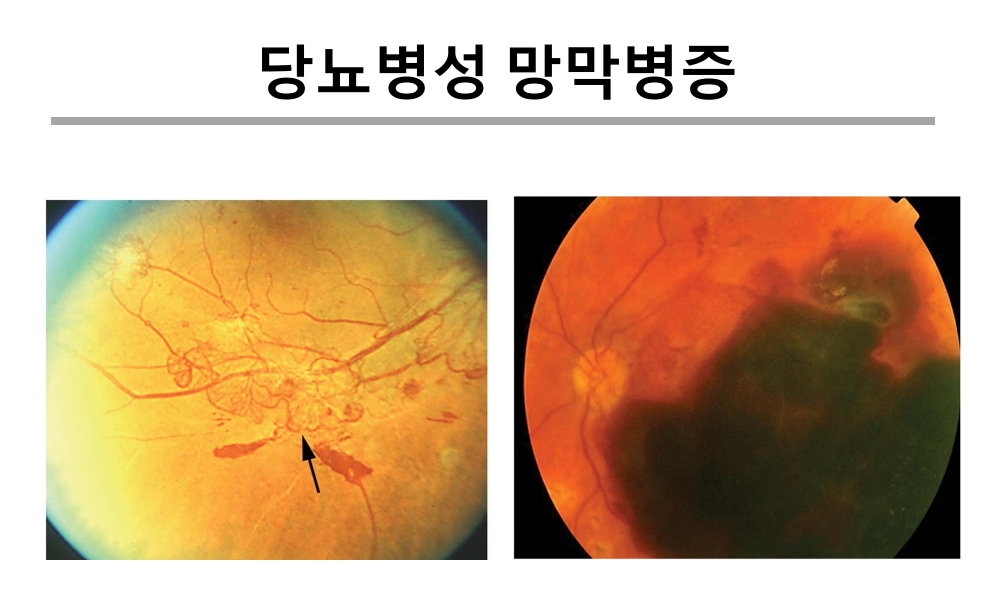 고혈당 위기 당뇨병성 케톤산증dka과 고삼투압성 고혈당 증후군hhs 완벽 가이드