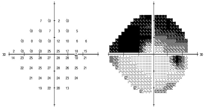 Humphrey VF 시야검사 정상 및 비정상, 녹내장 평가