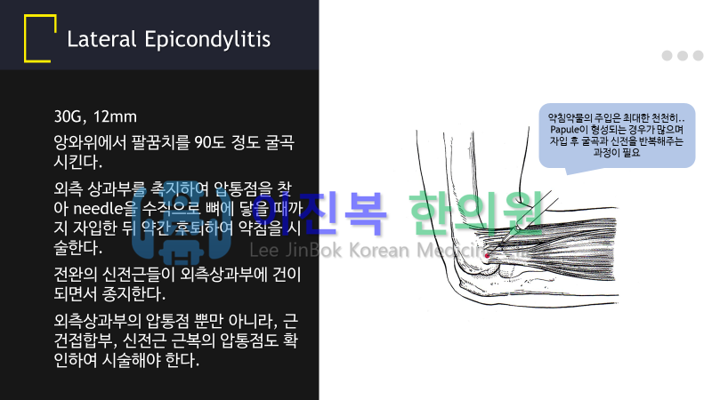 전주 이진복한의원 테니스엘보우외측 상과염