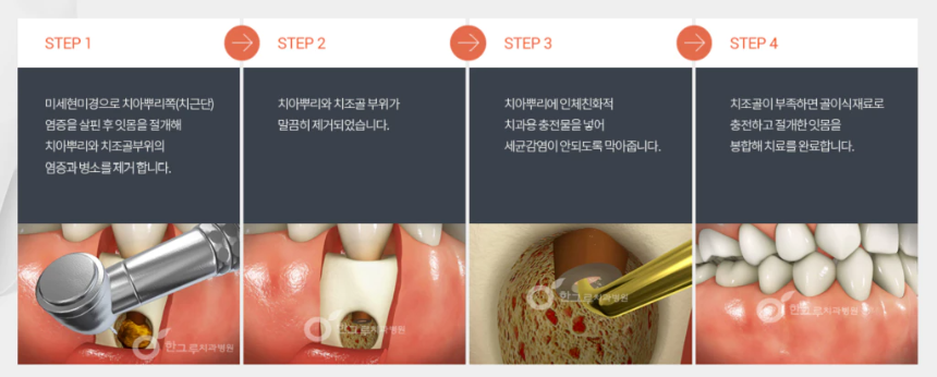 치근단 절제술 수술로 임플란트 대신 자연치아 보존 소미파파의 세상이야기