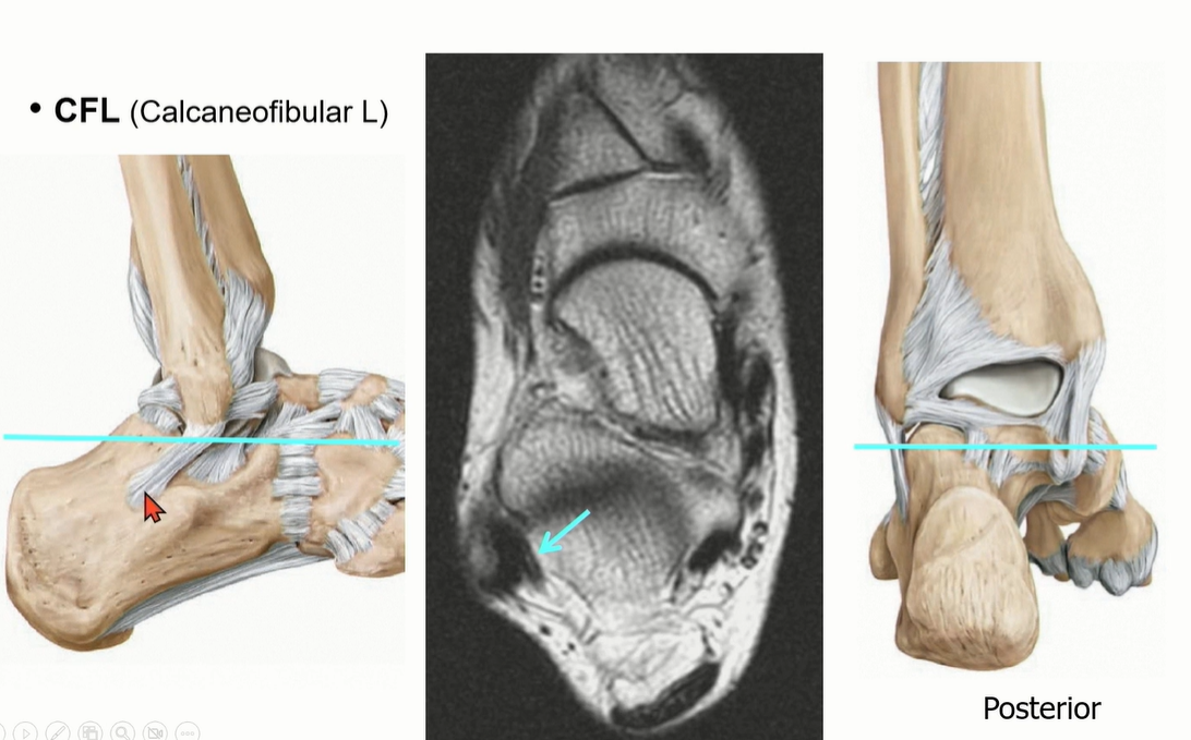 발목 MRI 공부_Ankle ligaments
