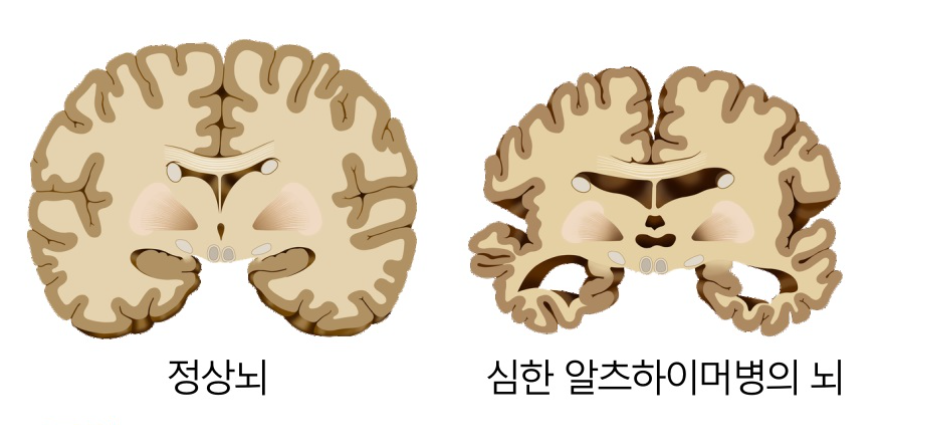 치매 조기 진단의 새로운 돌파구 조선대학교 연구팀의 혁신적 기술