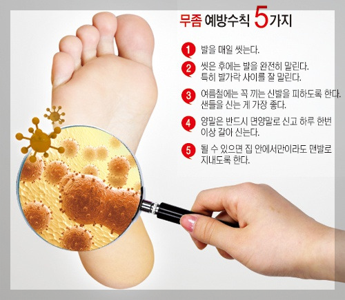 건강정보 발 무좀 증상과 원인 발 무좀약 추천 발바닥 발톱 무좀 없애는 방법