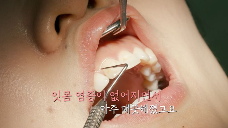 치과 의사들이 인정하는 잇몸 염증 막는 양치법 전격 공개 귀하신 몸