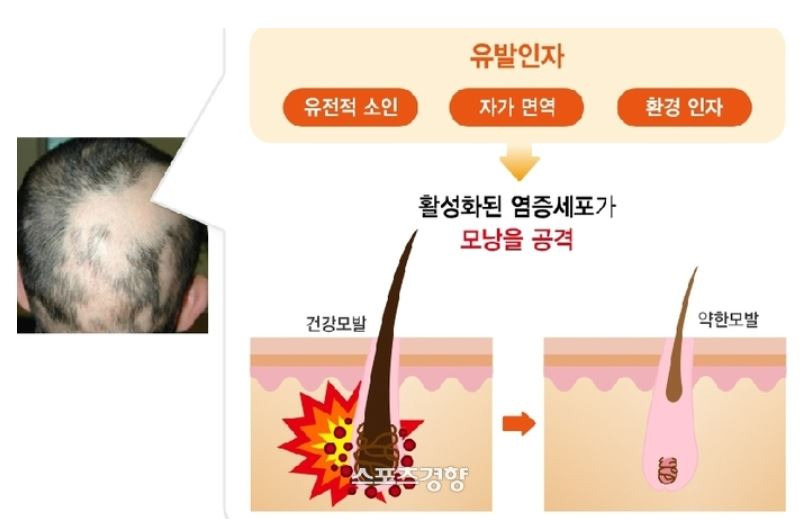 갑자기 찾아온 원형탈모 그 원인은 스트레스 No