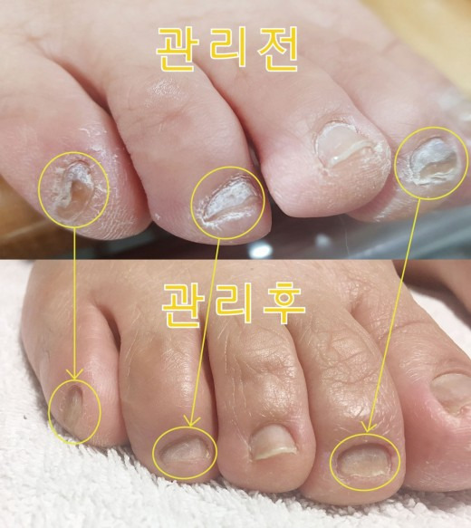 발톱무좀 없애는 방법 최신